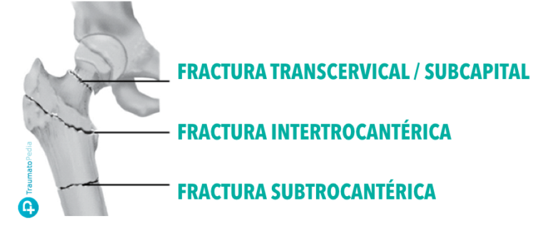 Entendiendo las fractura de cadera y su tratamiento - Traumatopedia Entendiendo las fractura de cadera y su tratamiento - Traumatopedia