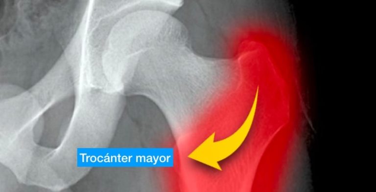 Trocanteritis - Síntomas, diagnóstico y tratamiento - Traumatopedia
