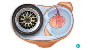 ¿Cómo saber si tengo el menisco roto? - ¿Tengo que operarme ...