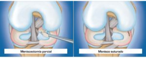 ¿Cómo saber si tengo el menisco roto? - ¿Tengo que operarme ...