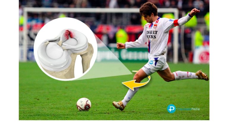 ¿Cómo saber si tengo el menisco roto? - ¿Tengo que operarme ...