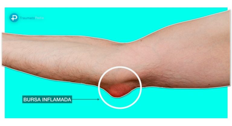 Tengo un bulto en el codo - Bursitis olecraniana - Traumatopedia