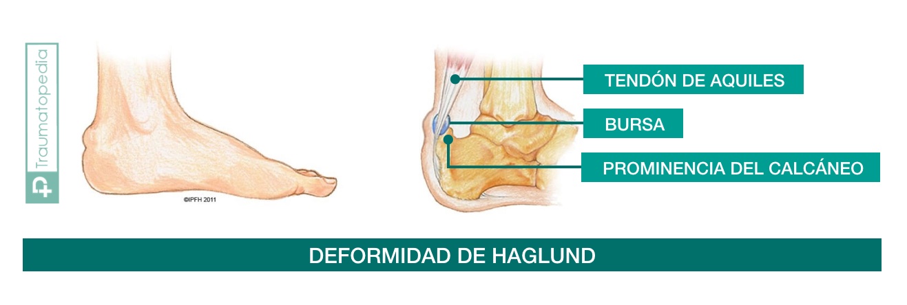Tengo un bulto en el talón del pie - Haglund - Traumatopedia