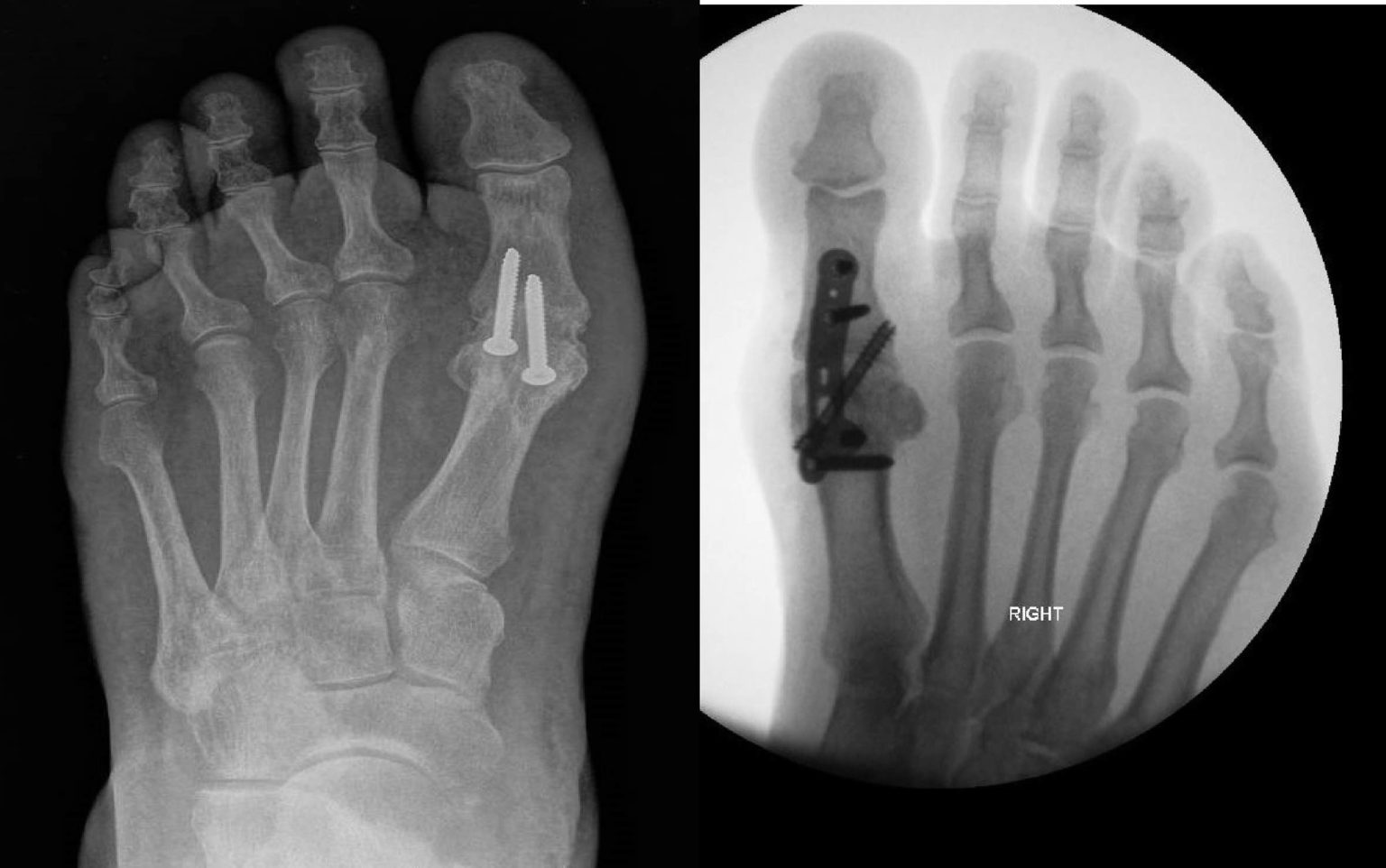 ¿Qué es el hallux rigidus? - Artrosis Metatarsofalángica - Traumatopedia