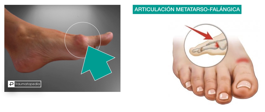 ¿Qué es el hallux rigidus? - Artrosis Metatarsofalángica - Traumatopedia