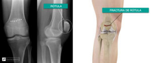 Fractura de rótula no desplazada - ¿Y Ahora qué? - Traumatopedia