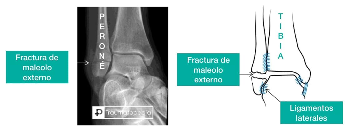 Fractura infrasindesmal del maleolo externo - Tratamiento - Traumatopedia