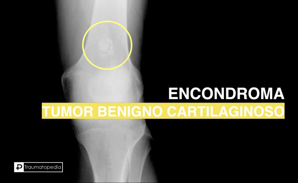 Tumores archivos - Traumatopedia